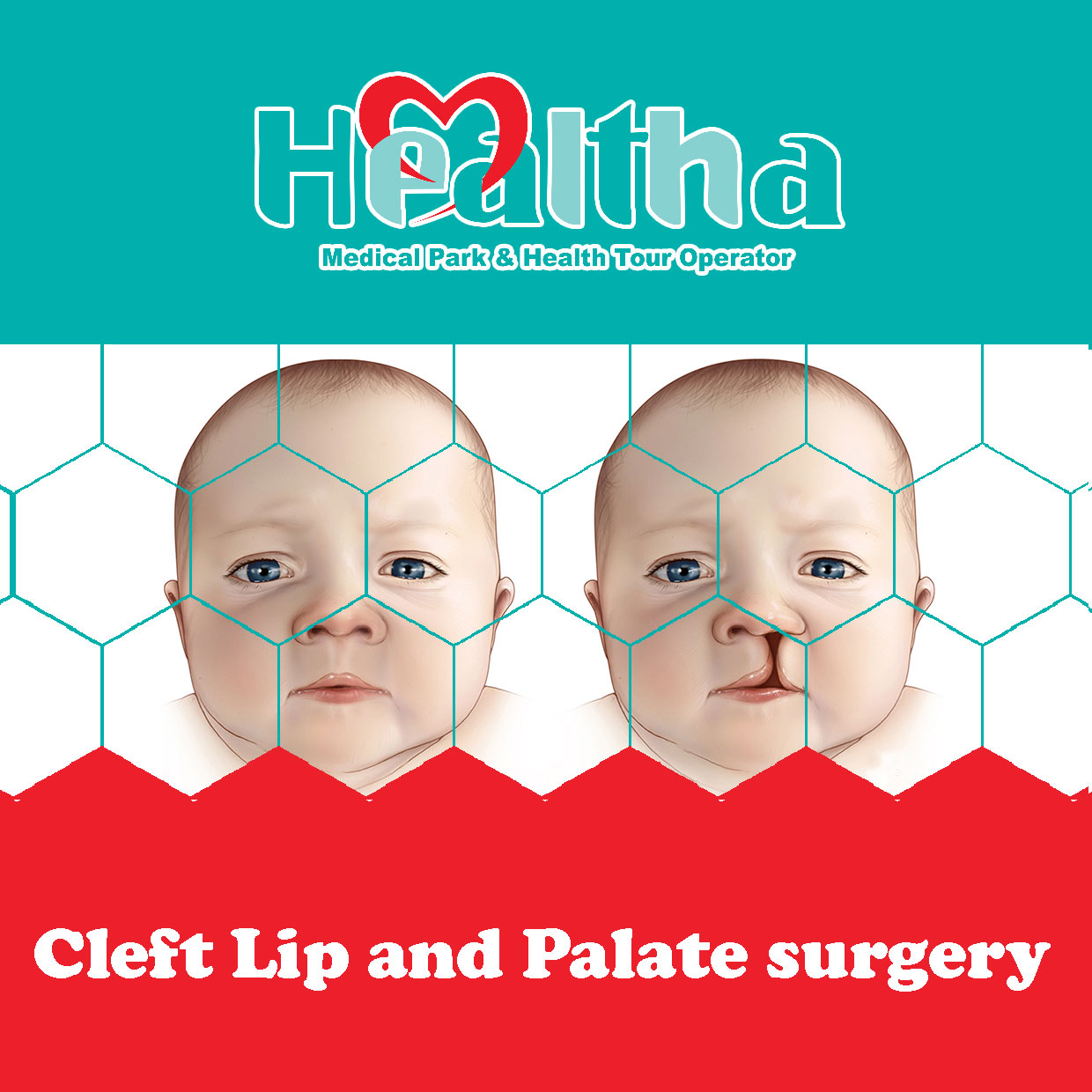 Cleft Lip And Palate Repair Surgery Healtha Medical Tourism In Iran