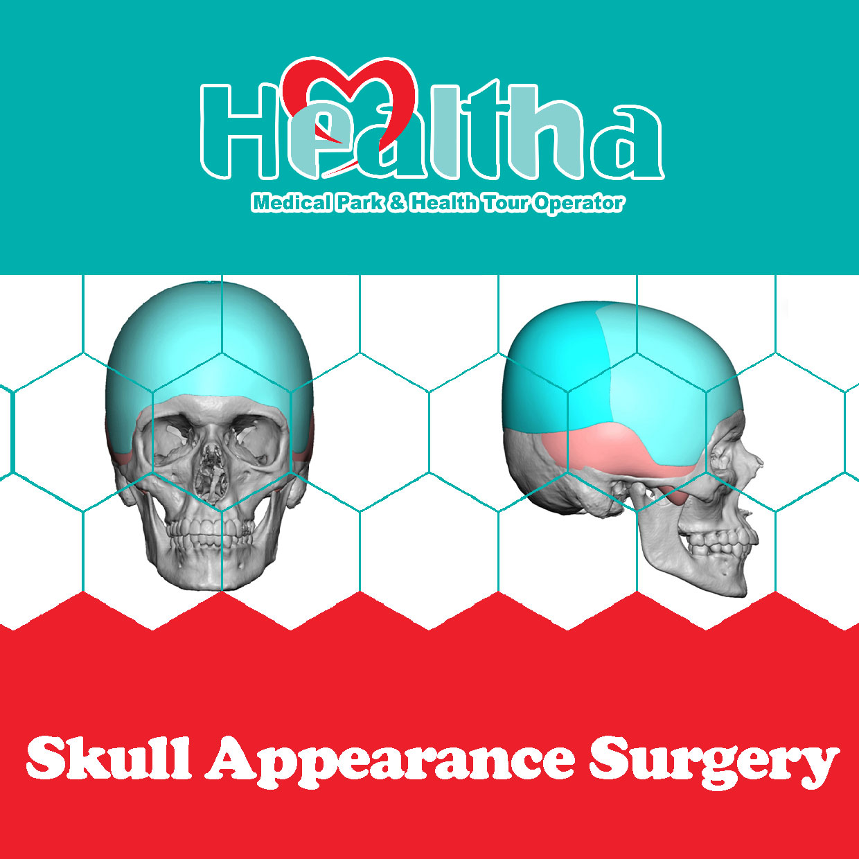 Skull Reshaping Surgery (cranioplasty) » Healtha - Medical Tourism In Iran