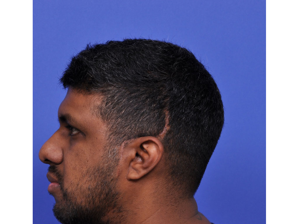 Skull Reshaping Surgery (cranioplasty) » Healtha - Medical Tourism In Iran