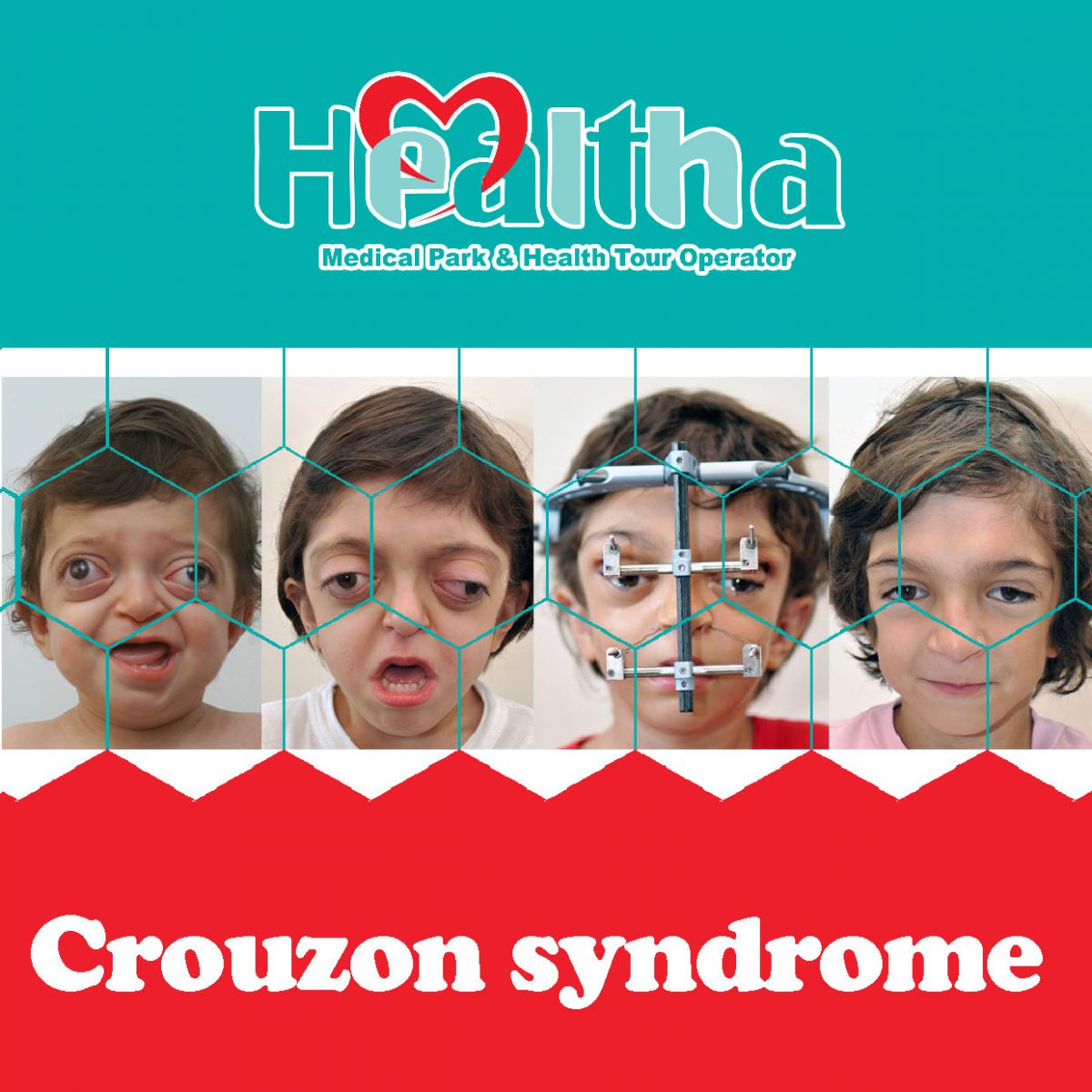 Crouzon syndrome – healtha